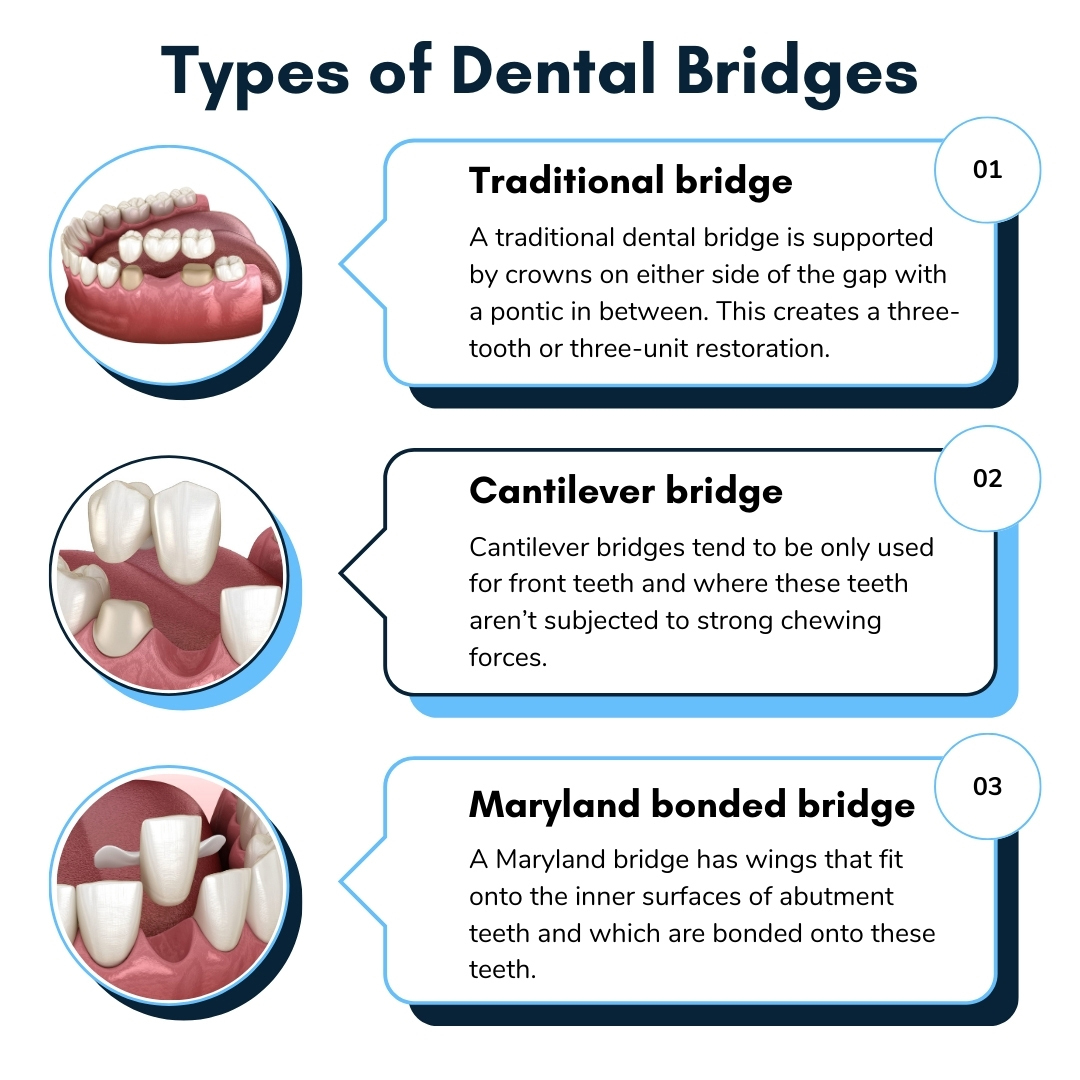 What is a Dental Bridge: Comprehensive Guide - Savannah Dental